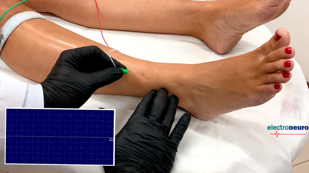 EMG Atlas - Eletroneuro - Neurofisiologia Clínica