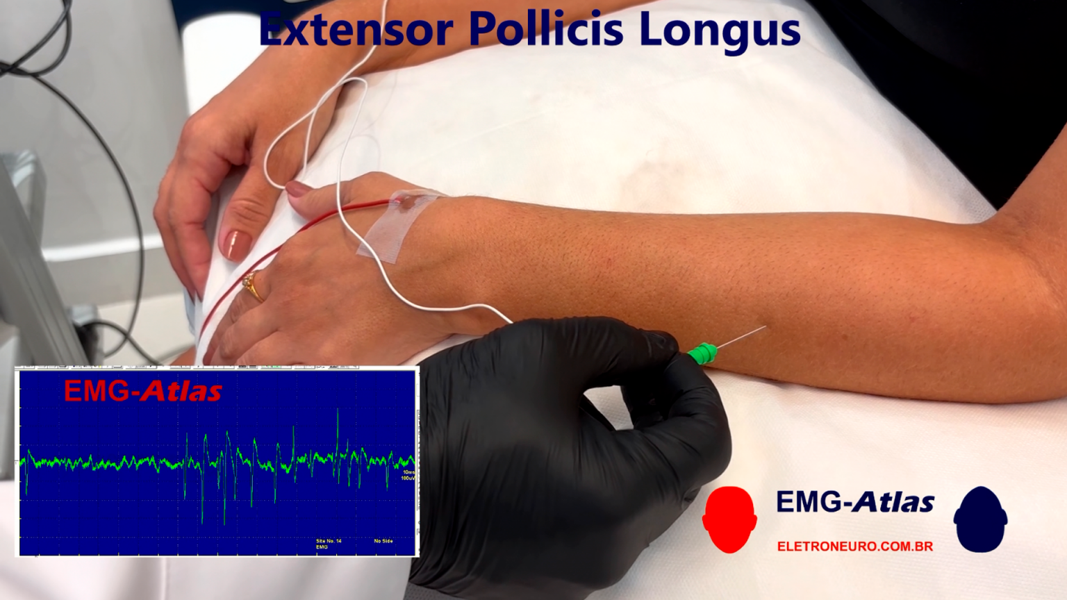EMG-Atlas - Eletroneuro - Neurofisiologia Clínica